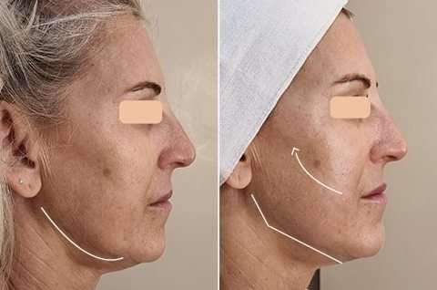 Non-surgical Skin Tightening, Best Beauty Hack - Skin Studio