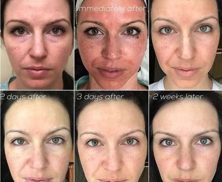 Microneedling, the ultimate skin-transformer - Skin Studio