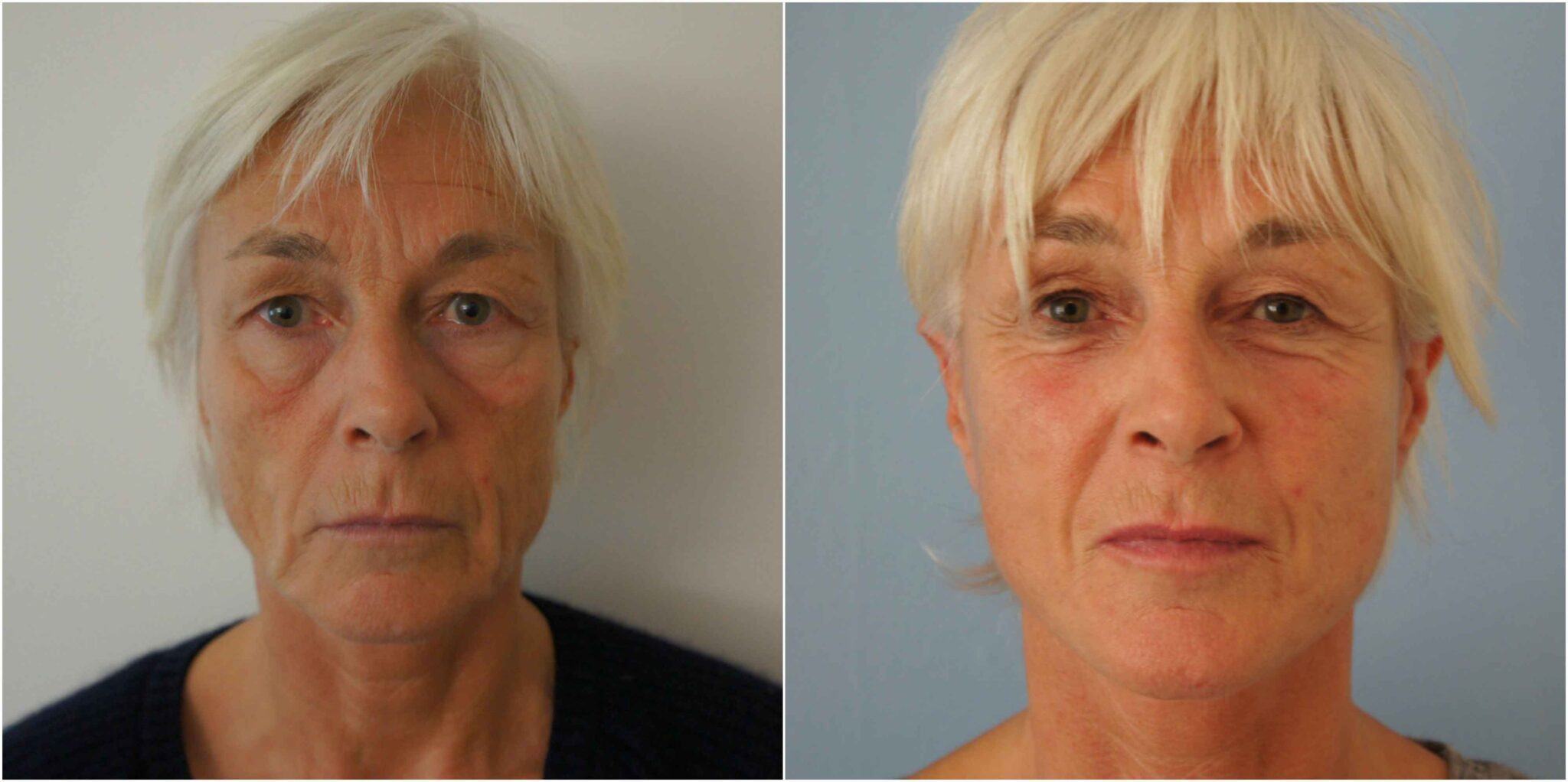 Mini Facelift In Istanbul | Signature Aesthetica (1 Hour)