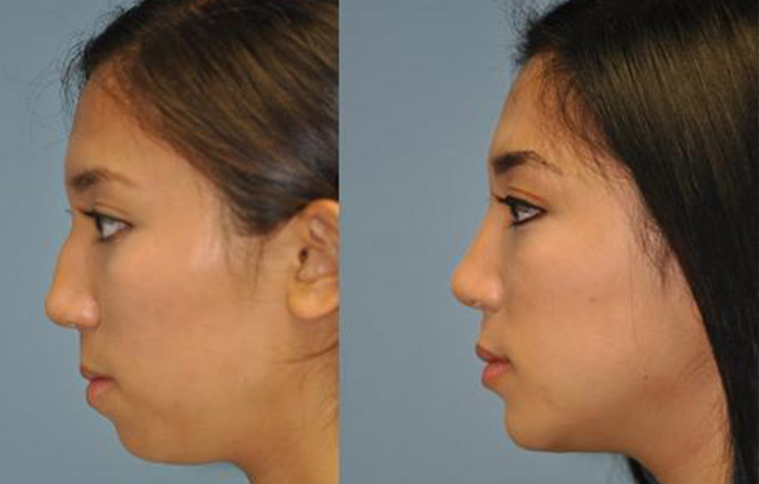 Chin Augmentation In Istanbul | Signature Aesthetica (1 Hour)